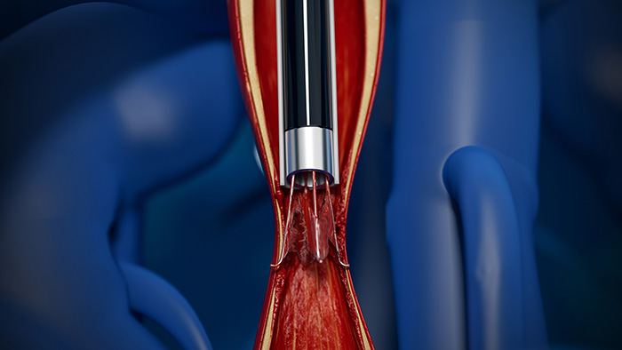 Percutane coronaire interventie (PCI) | Philips Healthcare